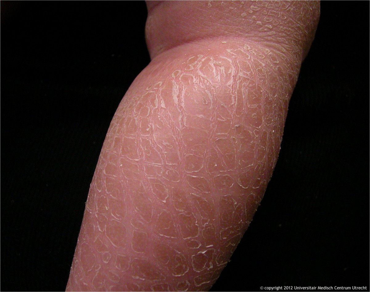 Sjögren Larsson Syndroom - Ichthyosis